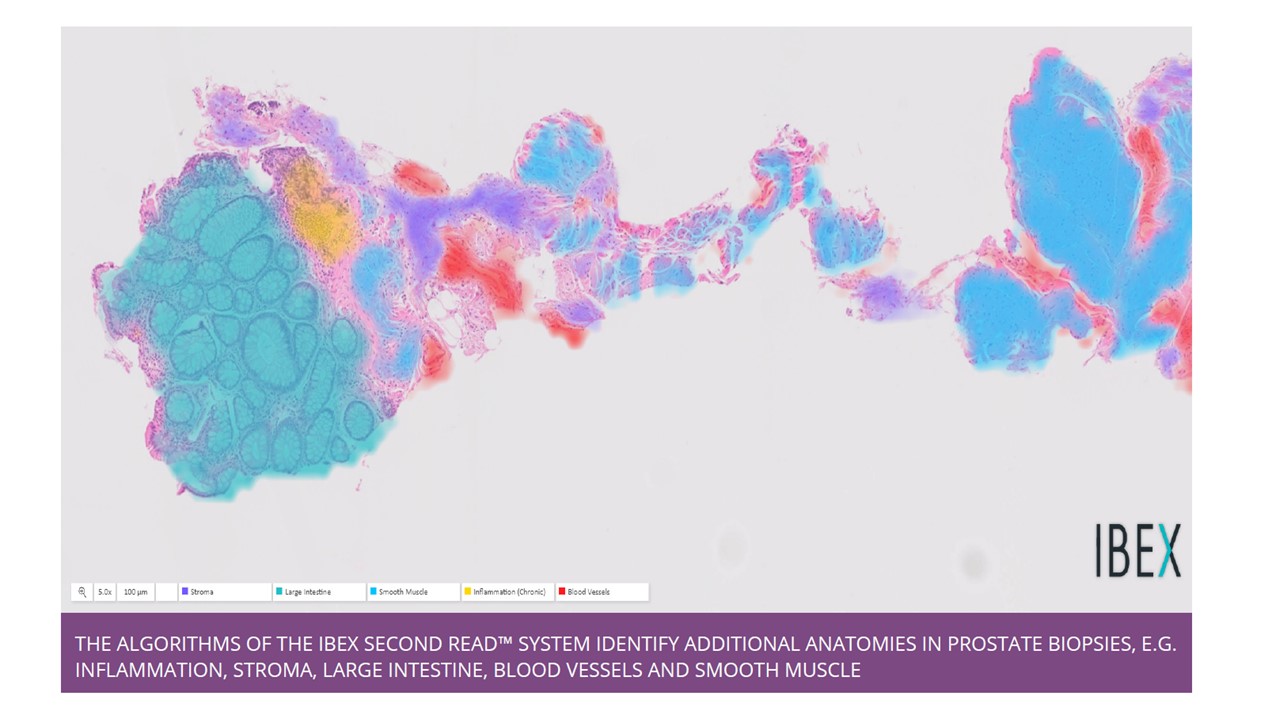 Inspirata and IBEX Medical Analytics Announce New Technical